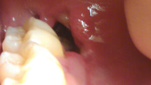 Dry Socket vs Clot: Everything You Need to Know - Web DMD