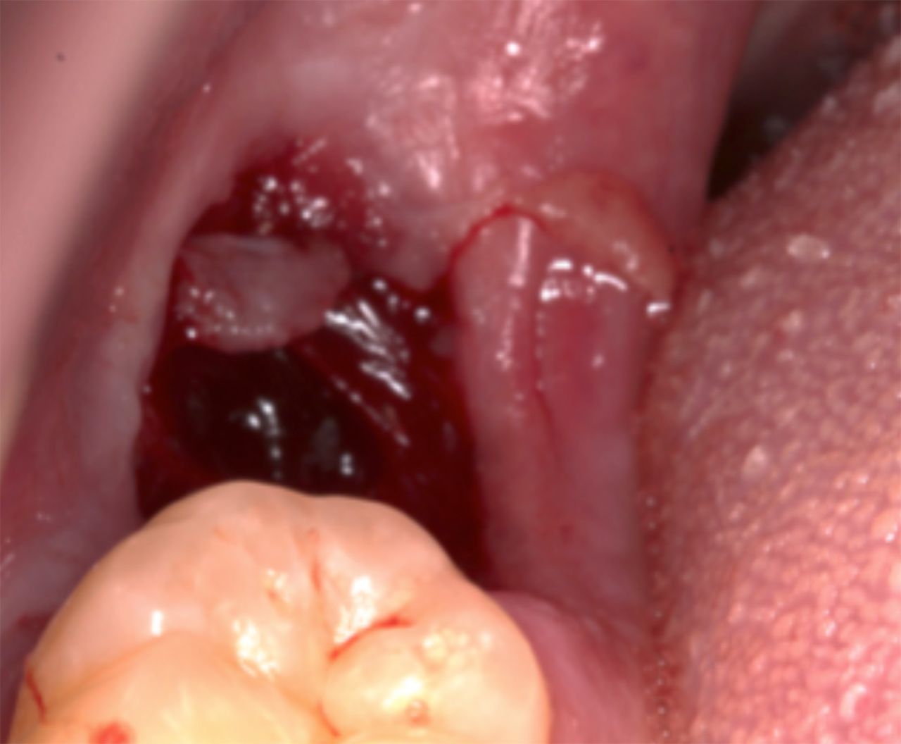 Dry Socket Vs Clot Everything You Need To Know DMD