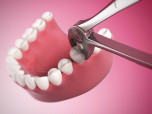 How Much Does a Tooth Extraction Cost? - Web DMD