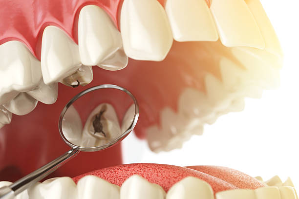 Can You Really Reverse A Cavity Dentists Answer Web DMD