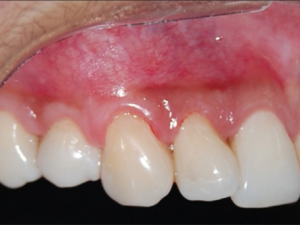 Pinhole Gum Surgery: What to Know - Web DMD