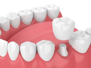 Is a Root Canal Without a Crown Right for Me? - Web DMD