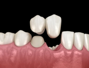 Dental Bridge: Complete Guide - Web DMD
