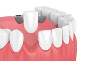 Dental Bridge: Complete Guide - Web DMD