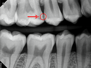 What Does a Cavity Look Like on an X-Ray? - Web DMD
