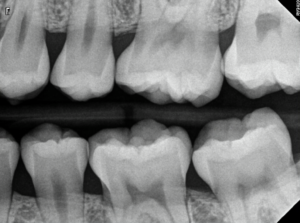 What Does a Cavity Look Like on an X-Ray? - Web DMD