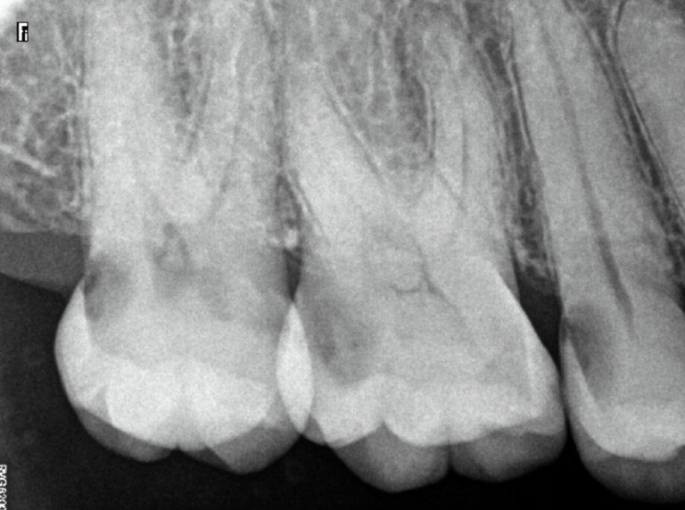 What Does a Cavity Look Like on an X-Ray? - Web DMD