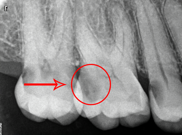 Tooth Abscess Stages: Pictures and Treatment Options - Web DMD