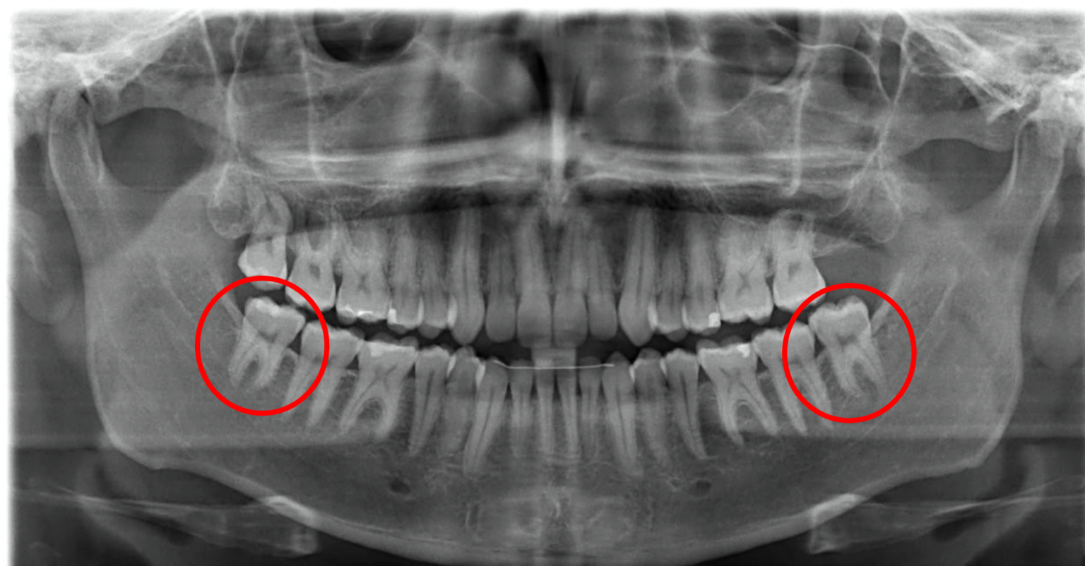 Wisdom Teeth: Real Pictures and Facts - Web DMD