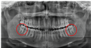 Wisdom Teeth: Real Pictures and Facts - Web DMD