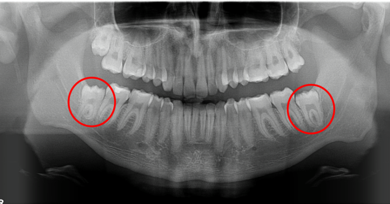 Wisdom Teeth: Real Pictures and Facts - Web DMD
