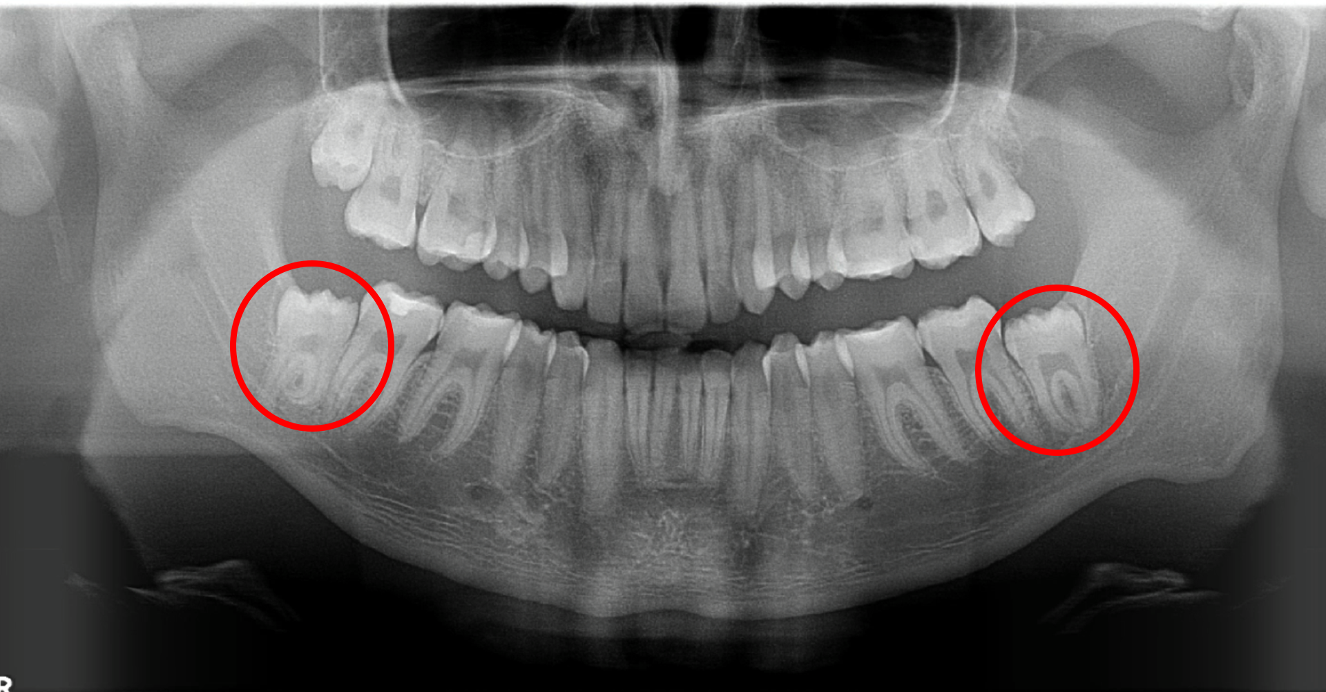 Wisdom Teeth: Real Pictures and Facts - Web DMD