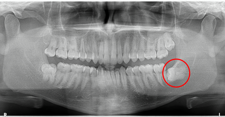 Wisdom Teeth: Real Pictures and Facts - Web DMD