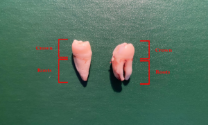 Wisdom Teeth: Real Pictures and Facts - Web DMD
