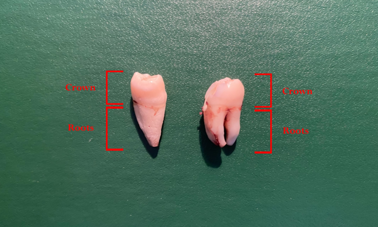 Wisdom Teeth: Real Pictures and Facts - Web DMD