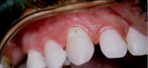 The 5 Stages of Tooth Decay - Web DMD