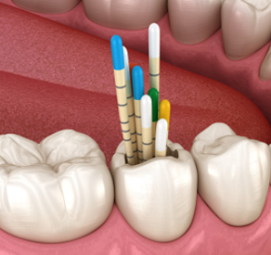 Root Canals: A Full Breakdown - Web DMD