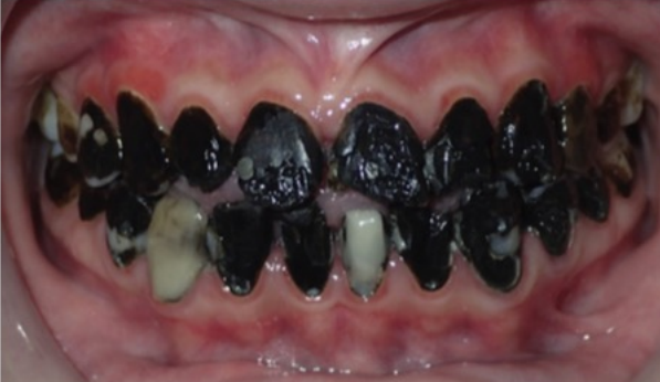 Understanding Fluoride Treatment: A Guide for Patients - Web DMD