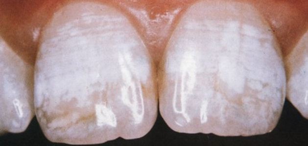 Understanding Fluoride Treatment: A Guide for Patients - Web DMD