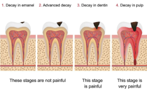 Fluoride Varnish: What You Need to Know - Web DMD