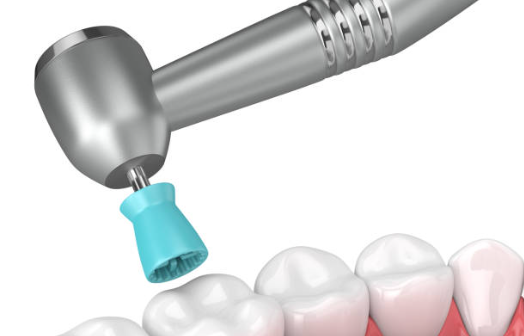 Understanding Dental Polishing - Web DMD