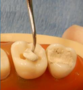 Temporary Tooth Fillings - Web DMD