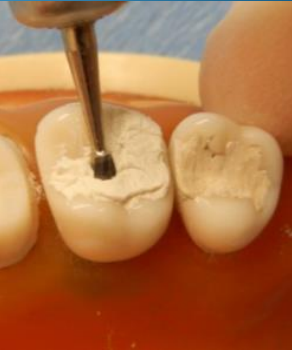 Temporary Tooth Fillings - Web DMD