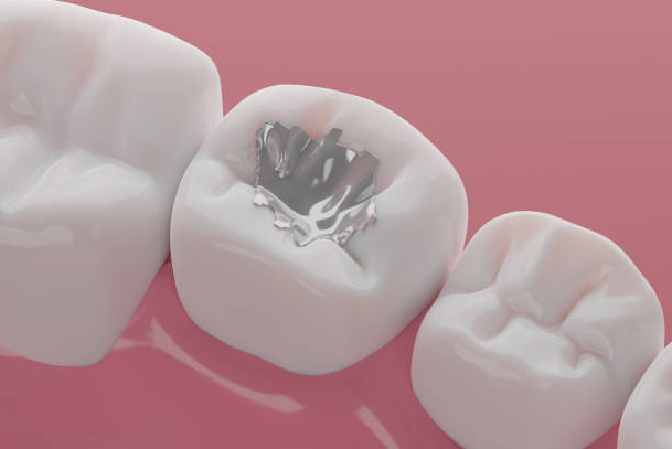 Amalgam Fillings - Web DMD