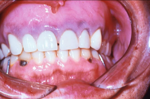 Immediate Dentures: Patient Guide - Web DMD