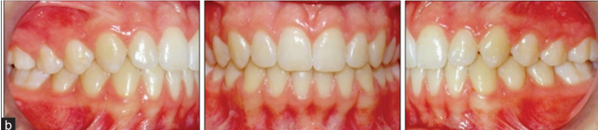 Dental Occlusion: How Your Teeth Fit Together - Web DMD