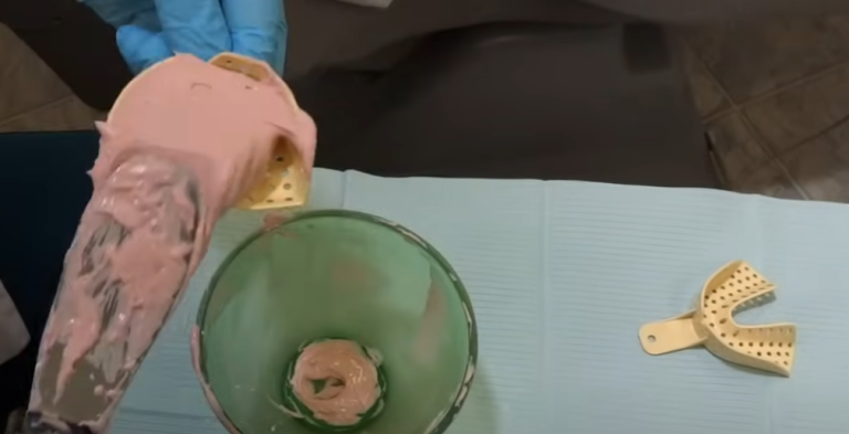 Dental Alginate Impressions - Web DMD