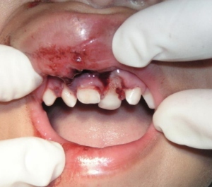 Understanding Tooth Trauma - Web DMD