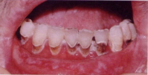 Xerostomia: Understanding Dry Mouth - Web DMD